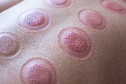 Getting Started: Your Essential Guide to Cupping Therapy – Medi Cupping ...